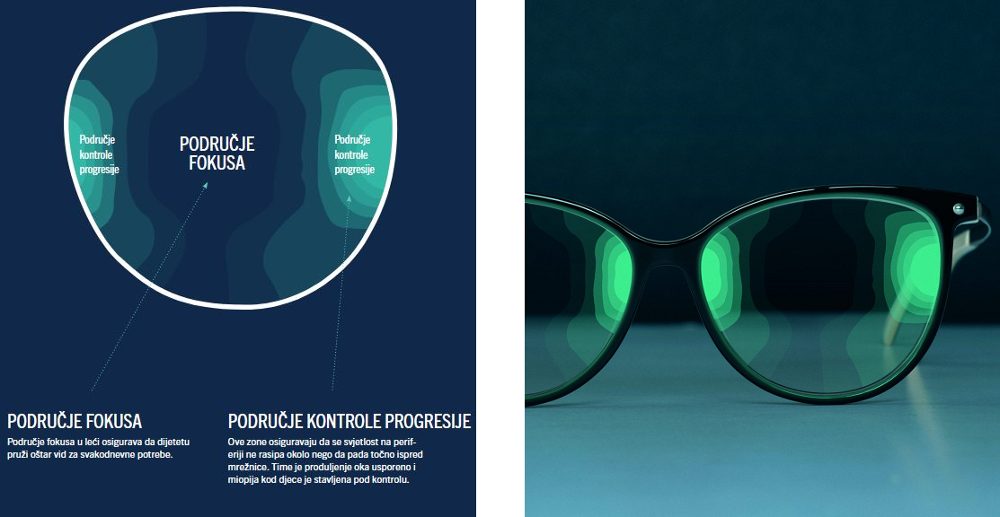 MyCon – nova opcija za dječju miopiju | www.optika-luna.hr